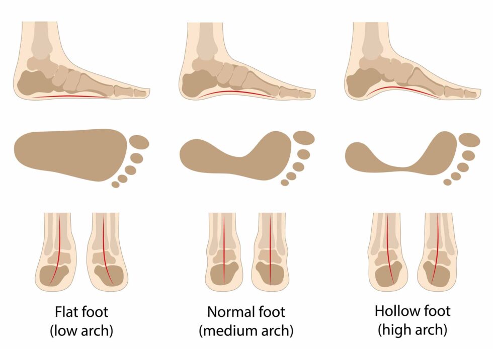 Flat Feet | Foot & Ankle Associates of Greater Pittsburgh